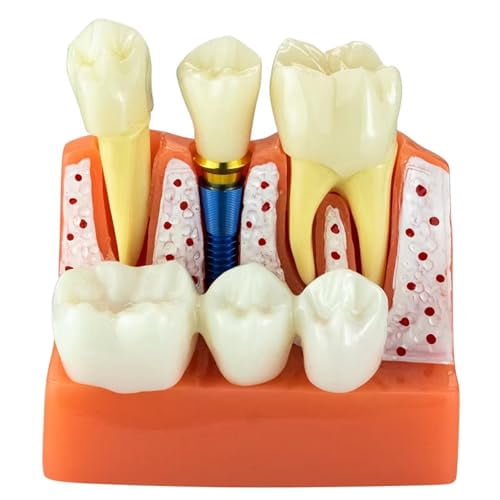 Dental Implant Model, 4 Times Transparent Teeth Model with Analysis ...