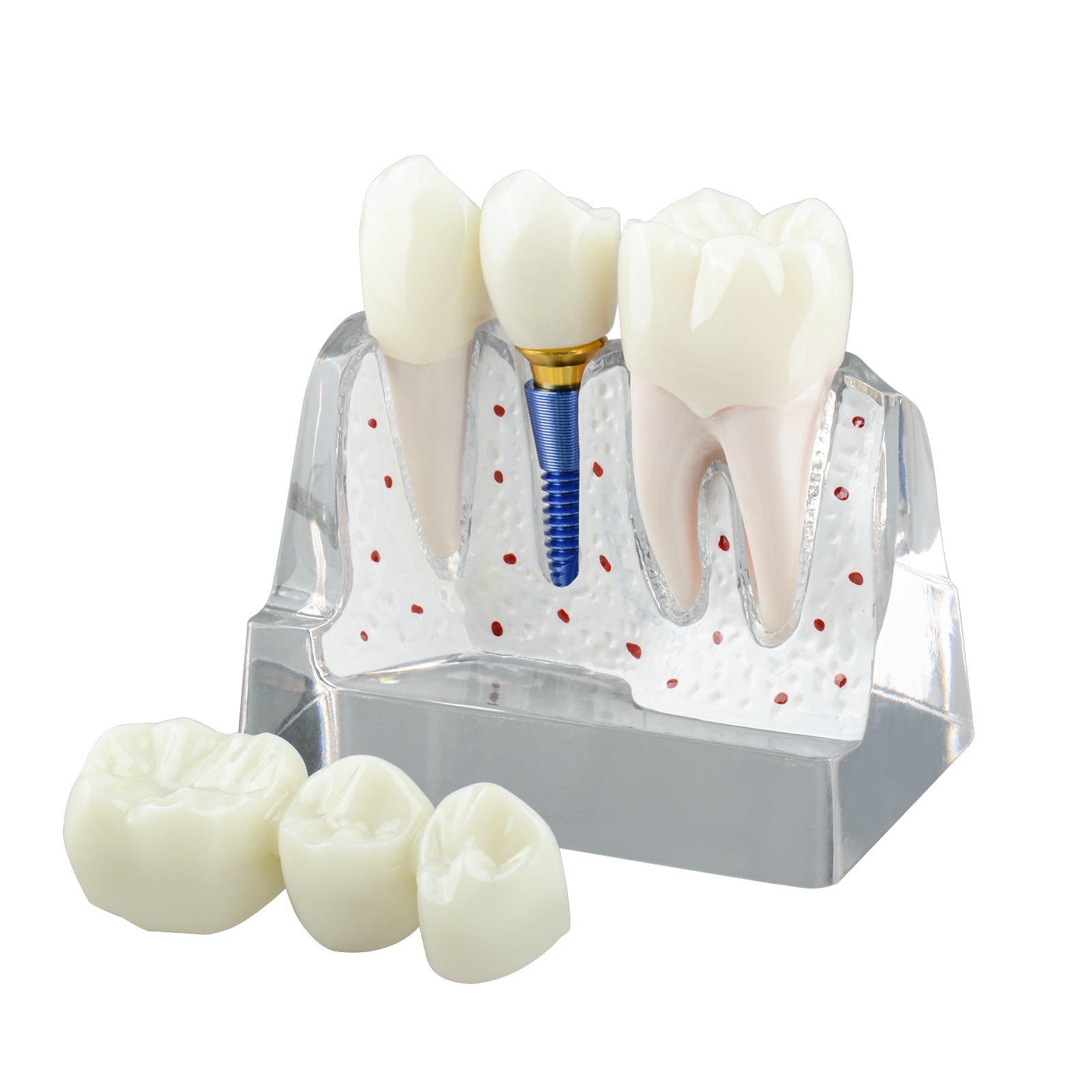 Dental Implant Model for Patient Education, 4 Times Dental Implant ...