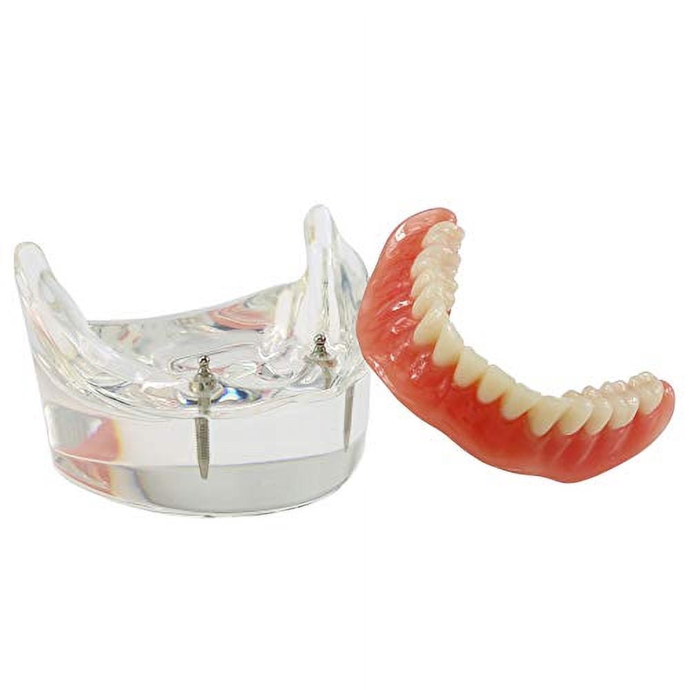 Dental Implant Teeth Demo Model Overdenture Restoration with 2 Implants ...