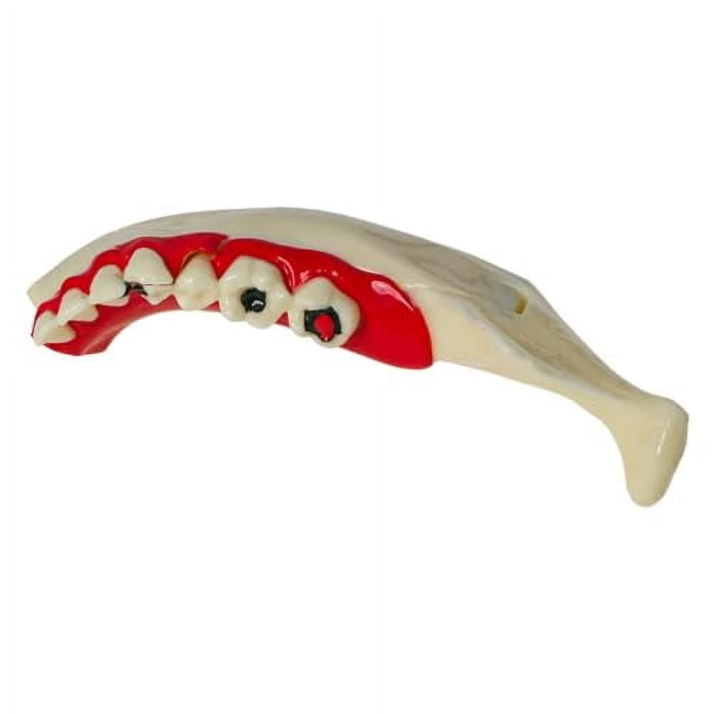 Dental Mandibular Decomposition Teeth Model Oral Caries and Root Cyst ...