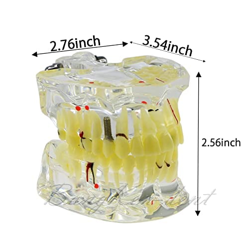 Dental Model, Typodont Pathological Tooth Models Caries, Dental Stones ...