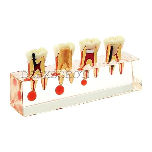 Dental Models, Typodont Demonstration of Deciduous Tooth Caries ...