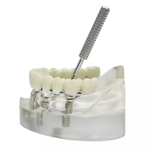 Dental Overdenture Teeth Model, Transparent Upper/Lower jaw implant ...