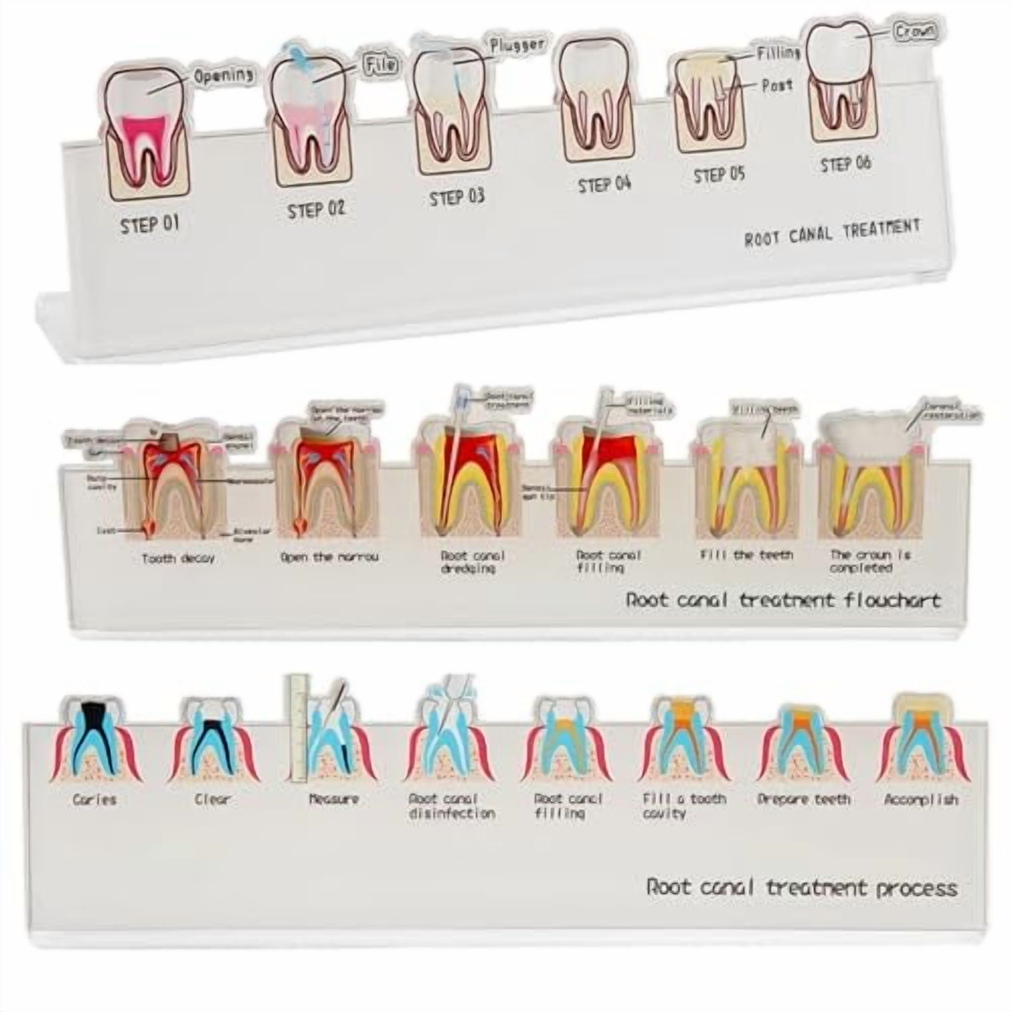Dental Root Canal Treatment Flowchart Stand, Periodontal Disease ...