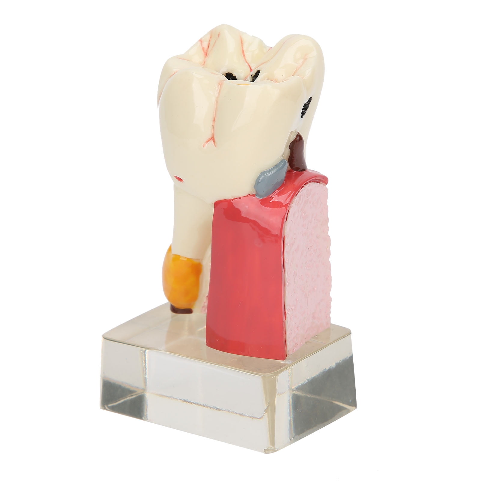 Dental Teeth Model 6 Times Caries Teeth Models for Dentist Studying ...