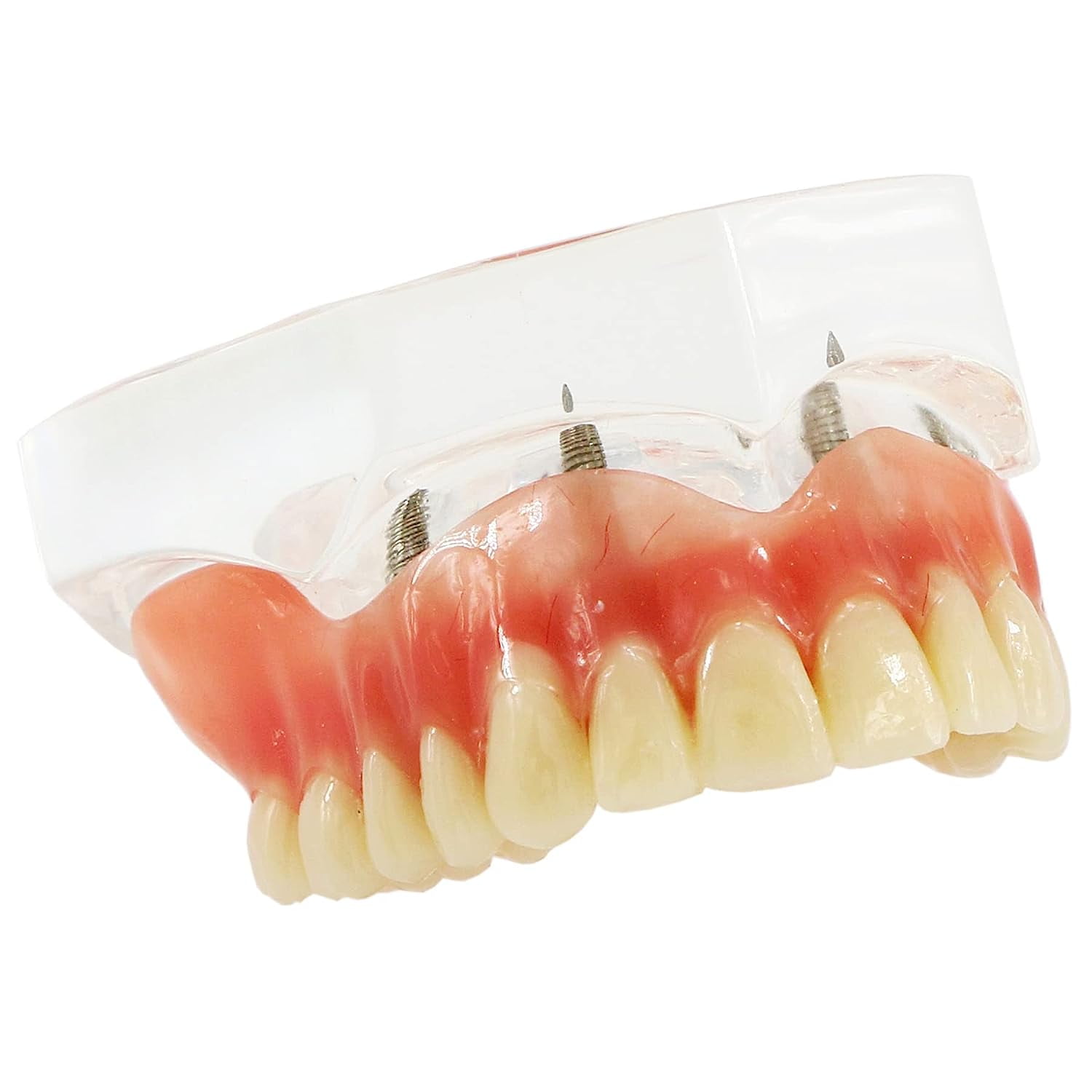 Dental Upper Implants Model Overdenture with 4 Teeth Demo Transparent ...