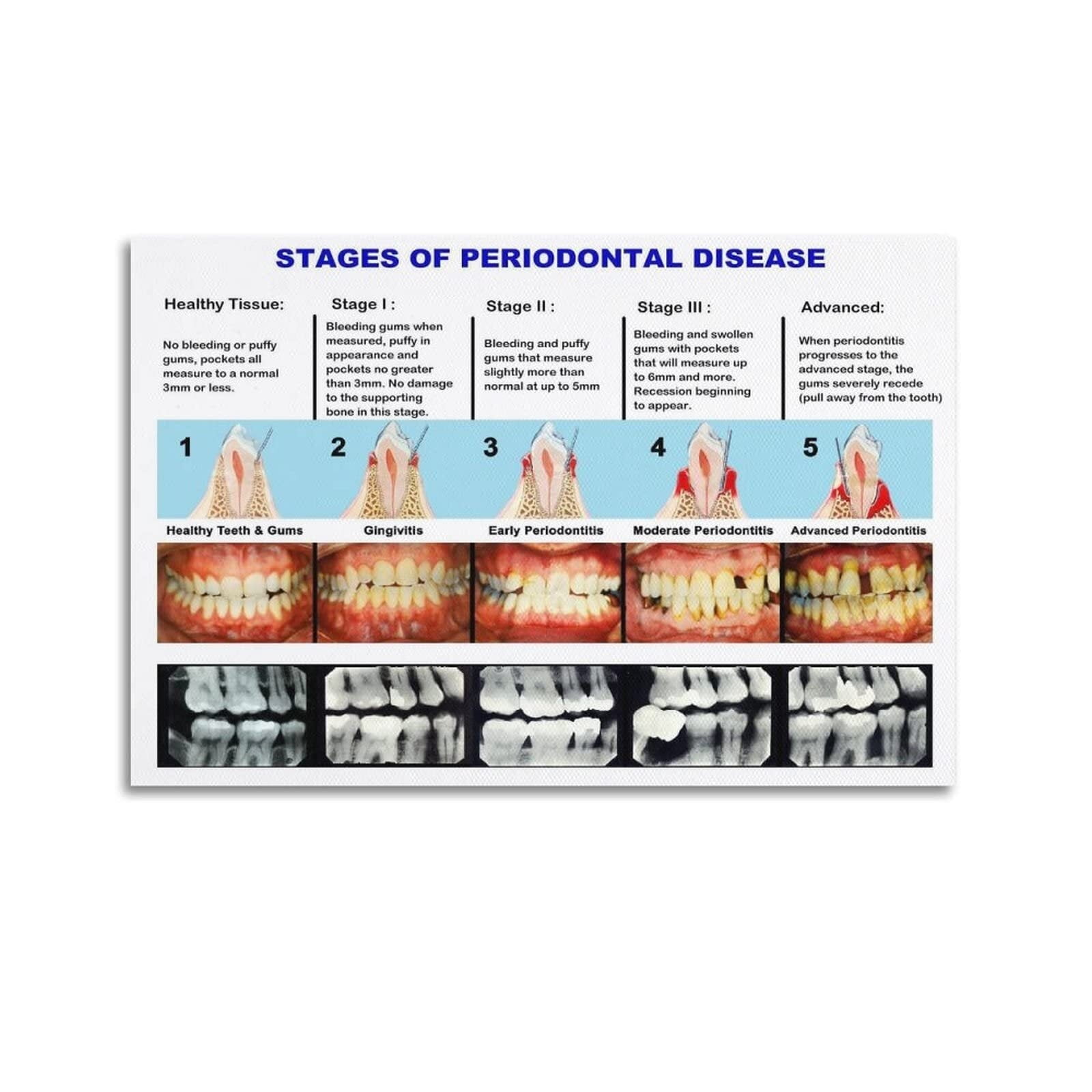 Dentist Poster Vintage Stages of Periodontal Psoter Disease Teeths ...