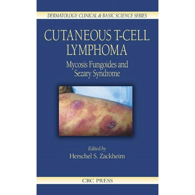 Dermatology: Clinical & Basic Science: Cutaneous T-Cell Lymphoma ...