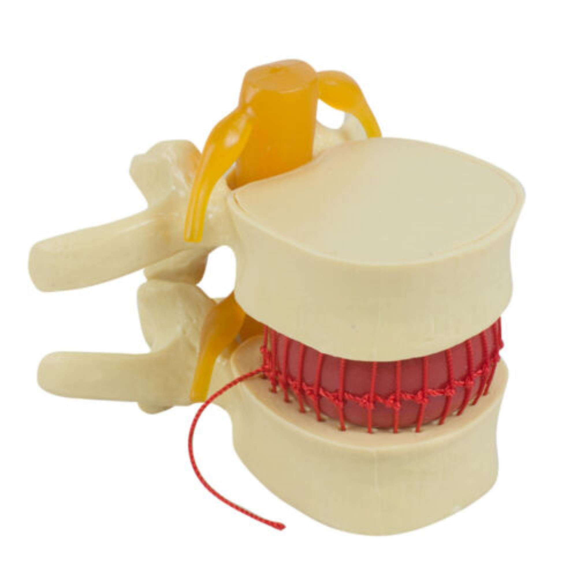 Detailed PVC Spine Model for Lumbar Disc Herniation - Realistic Anatomy ...