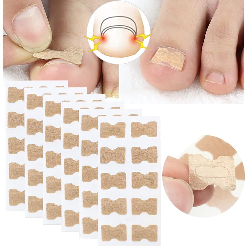 Dicasser 100Pcs Ingrown Toenail Correction Stickers Toenail Corrector ...