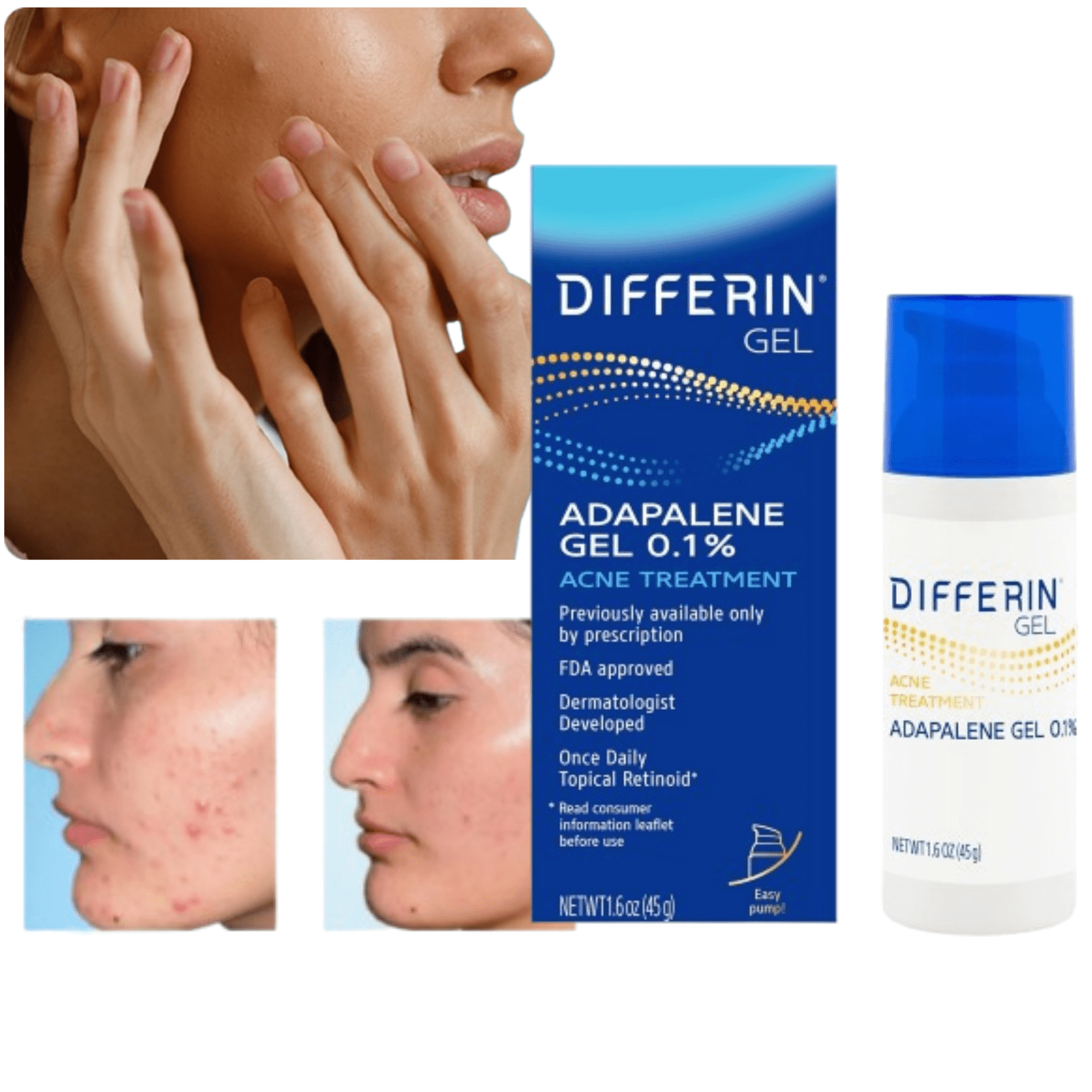 Differin Acne Treatment Gel, 90 Day Supply, Retinoid Treatment for Face ...