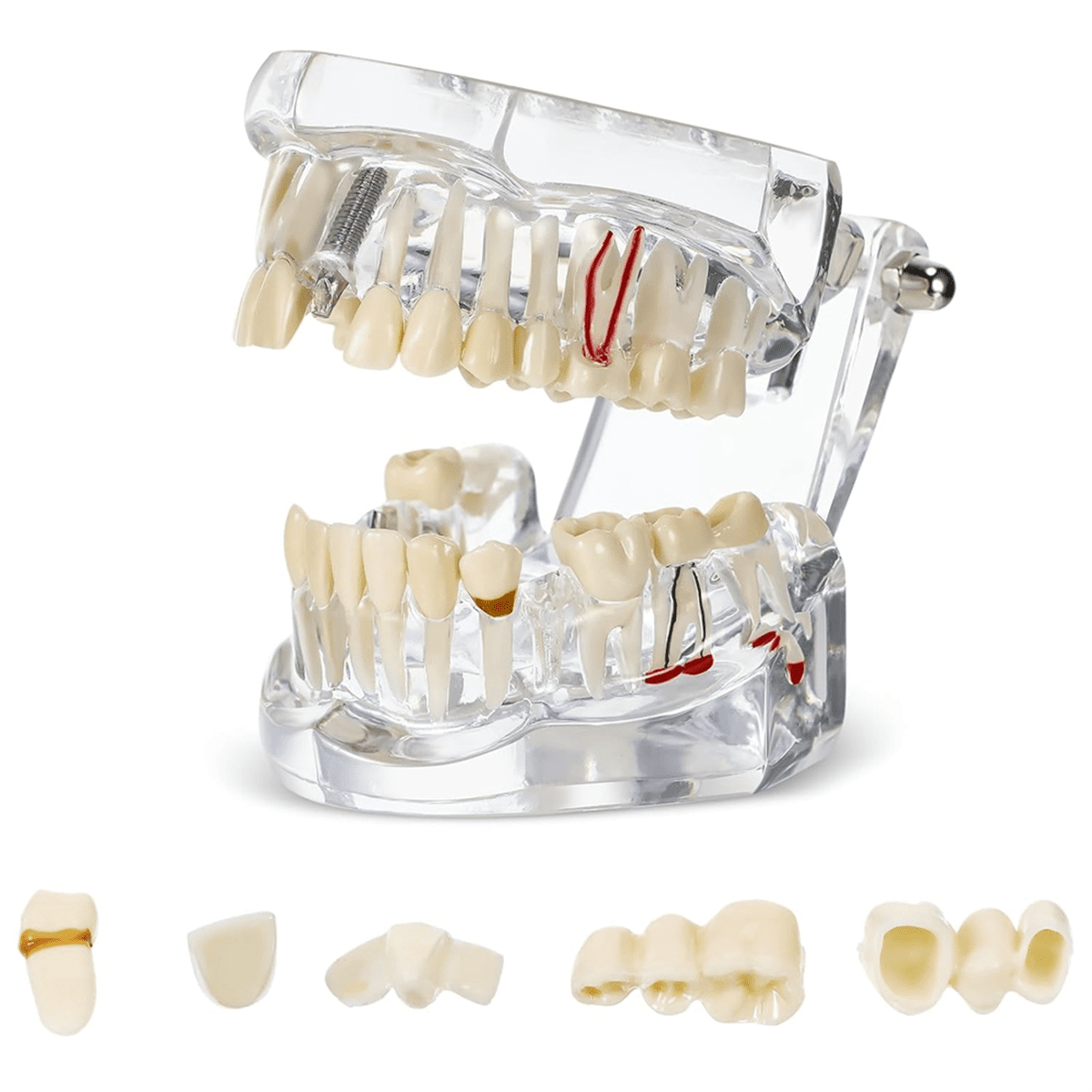 Disease Teeth Model Dental Typodonts Implant with Removable Dentist ...