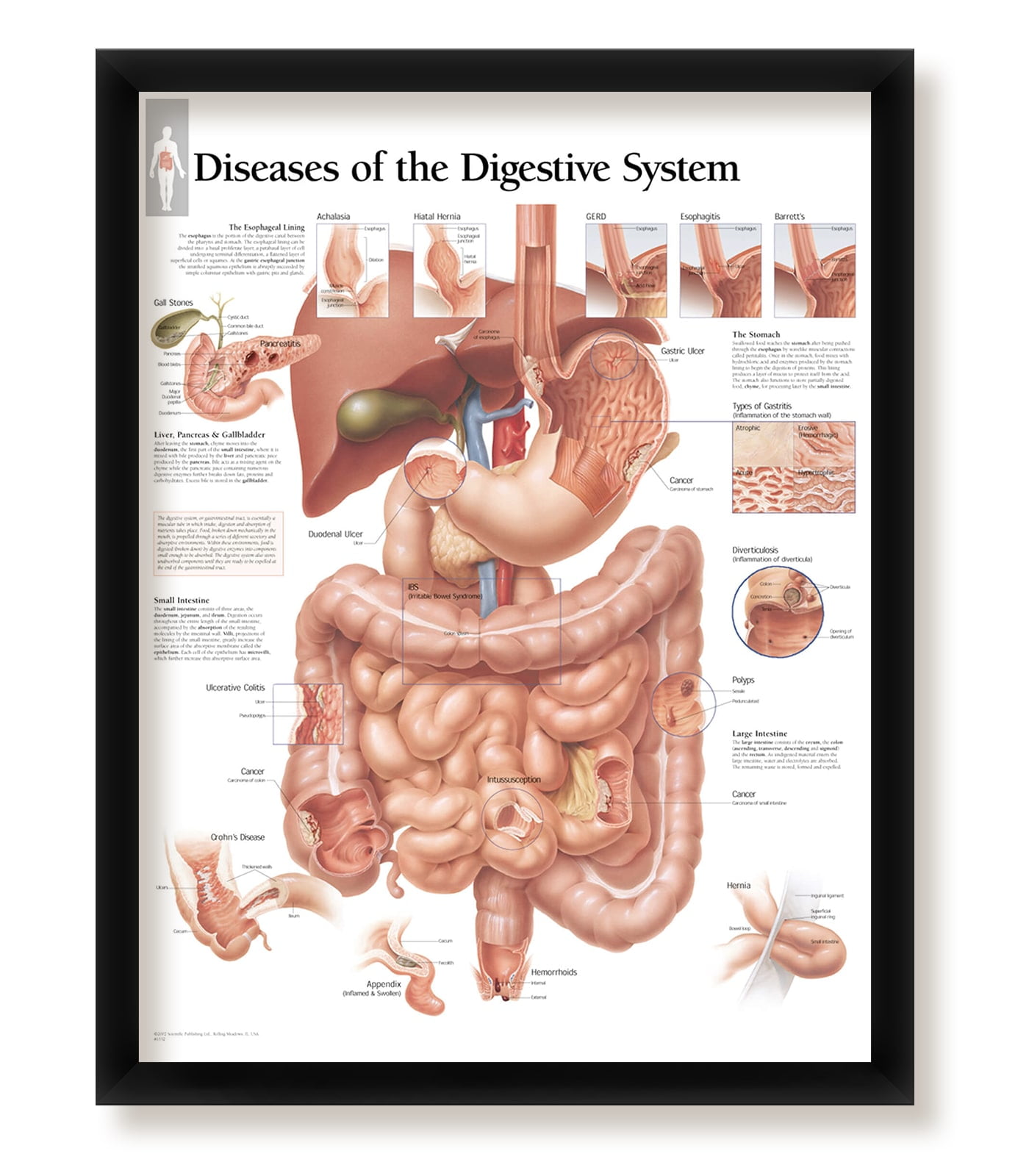 Diseases of The Digestive System Framed Medical Educational ...