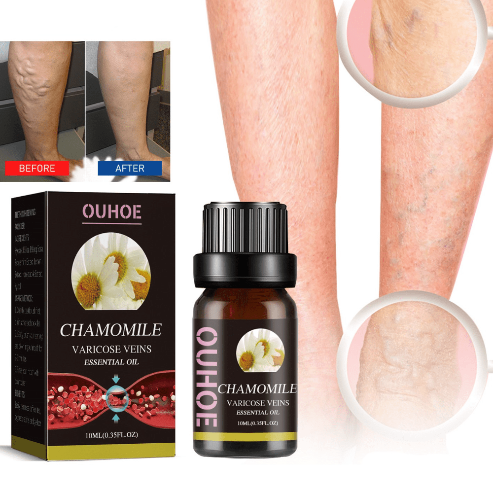 ELEWELT Chamomile Oil for Varicose Veins, Chamomile Oil Varicose Veins ...