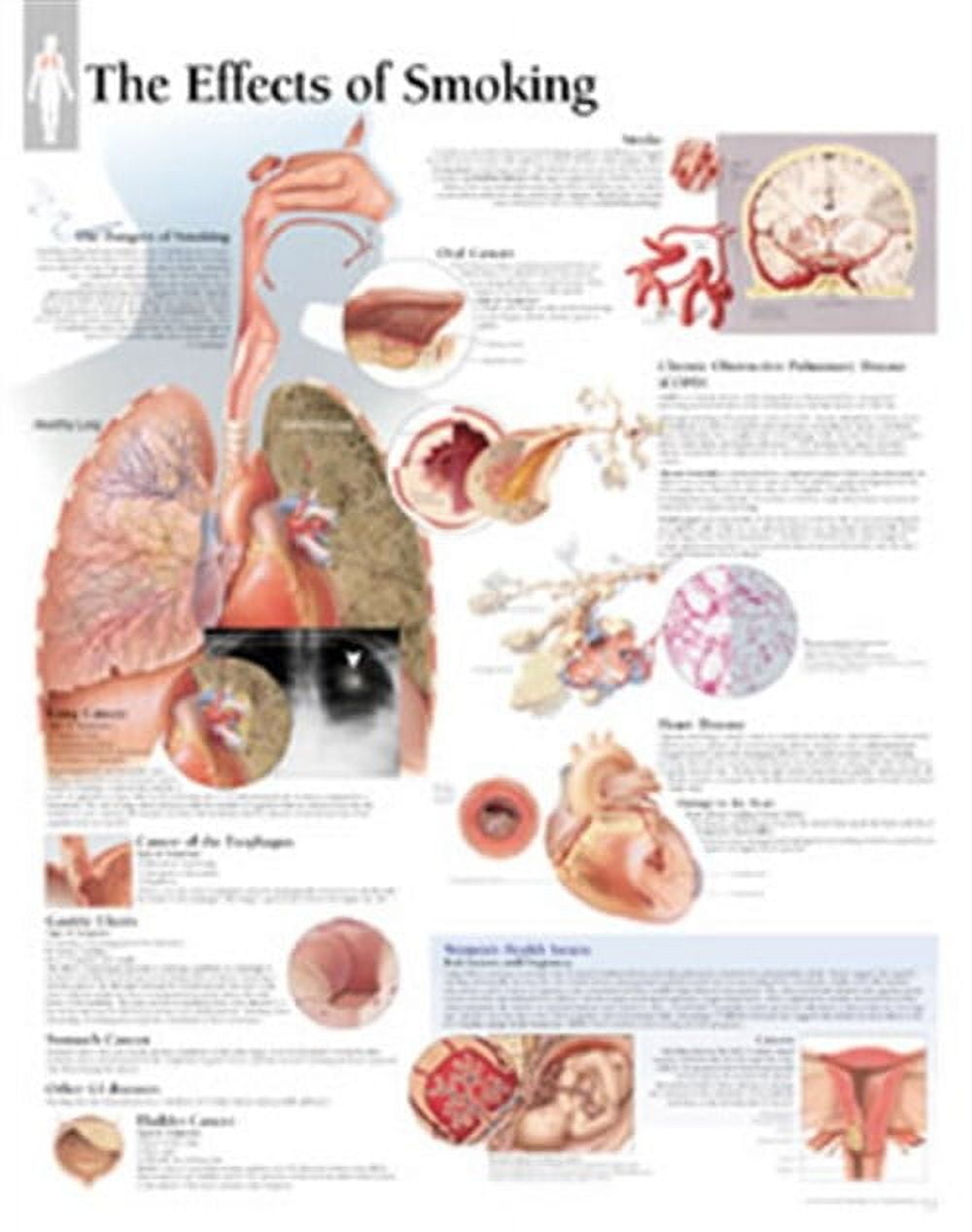 Effects of Smoking, Laminated Chart - Walmart.com