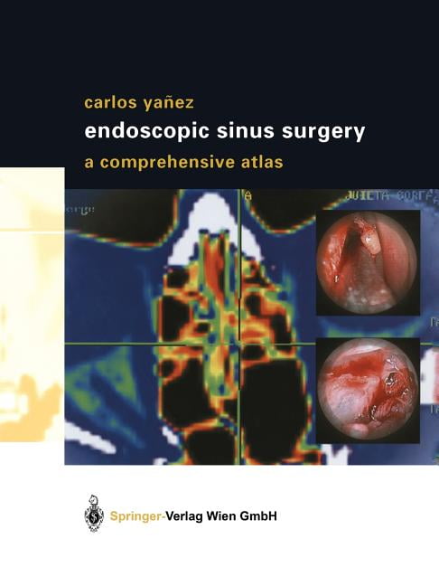 Endoscopic Sinus Surgery: A Comprehensive Atlas, (Paperback) - Walmart.com