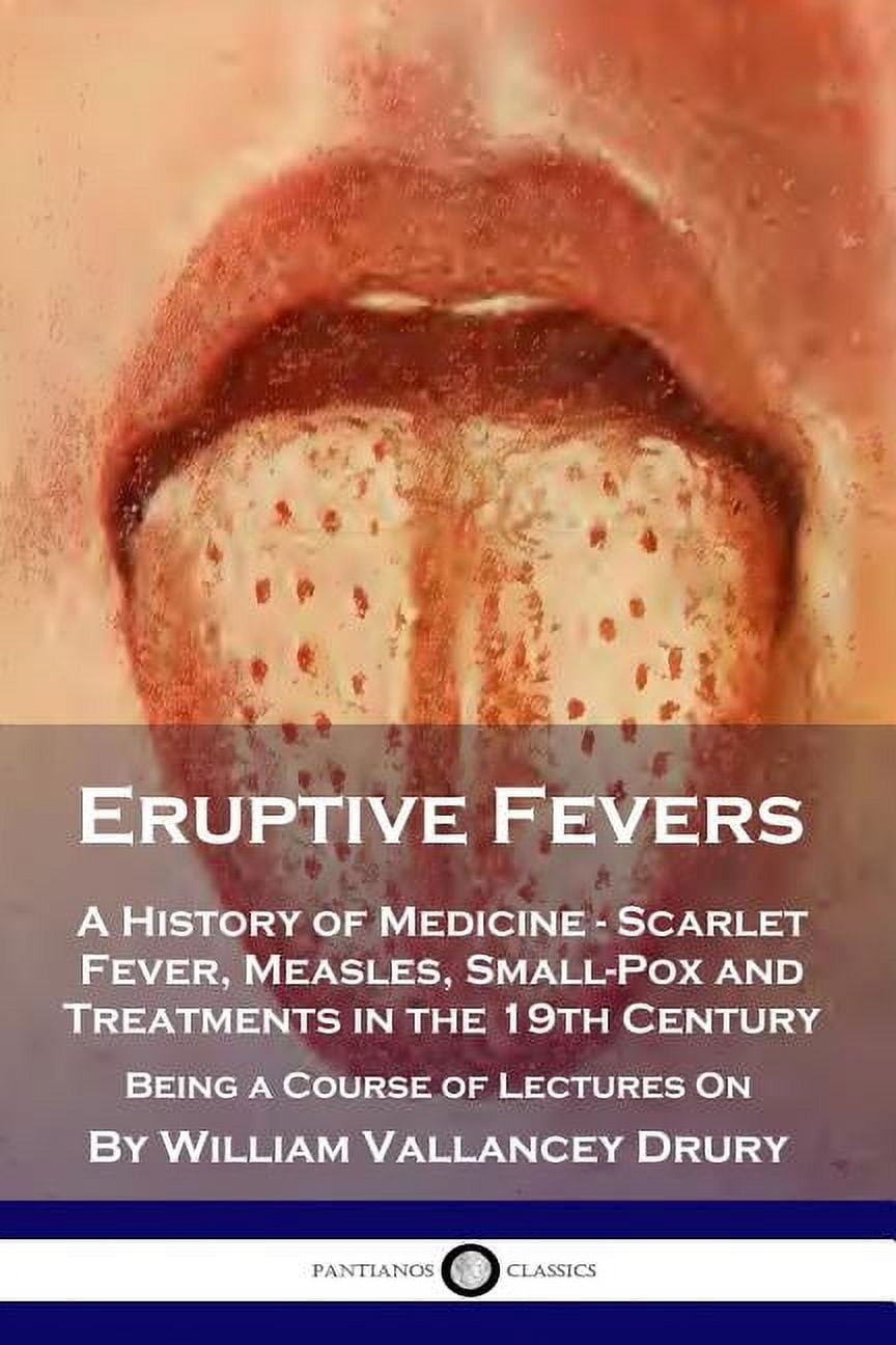 Eruptive Fevers: A History of Medicine - Scarlet Fever, Measles, Small ...