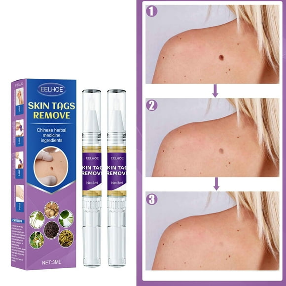 Skin Tag Remover