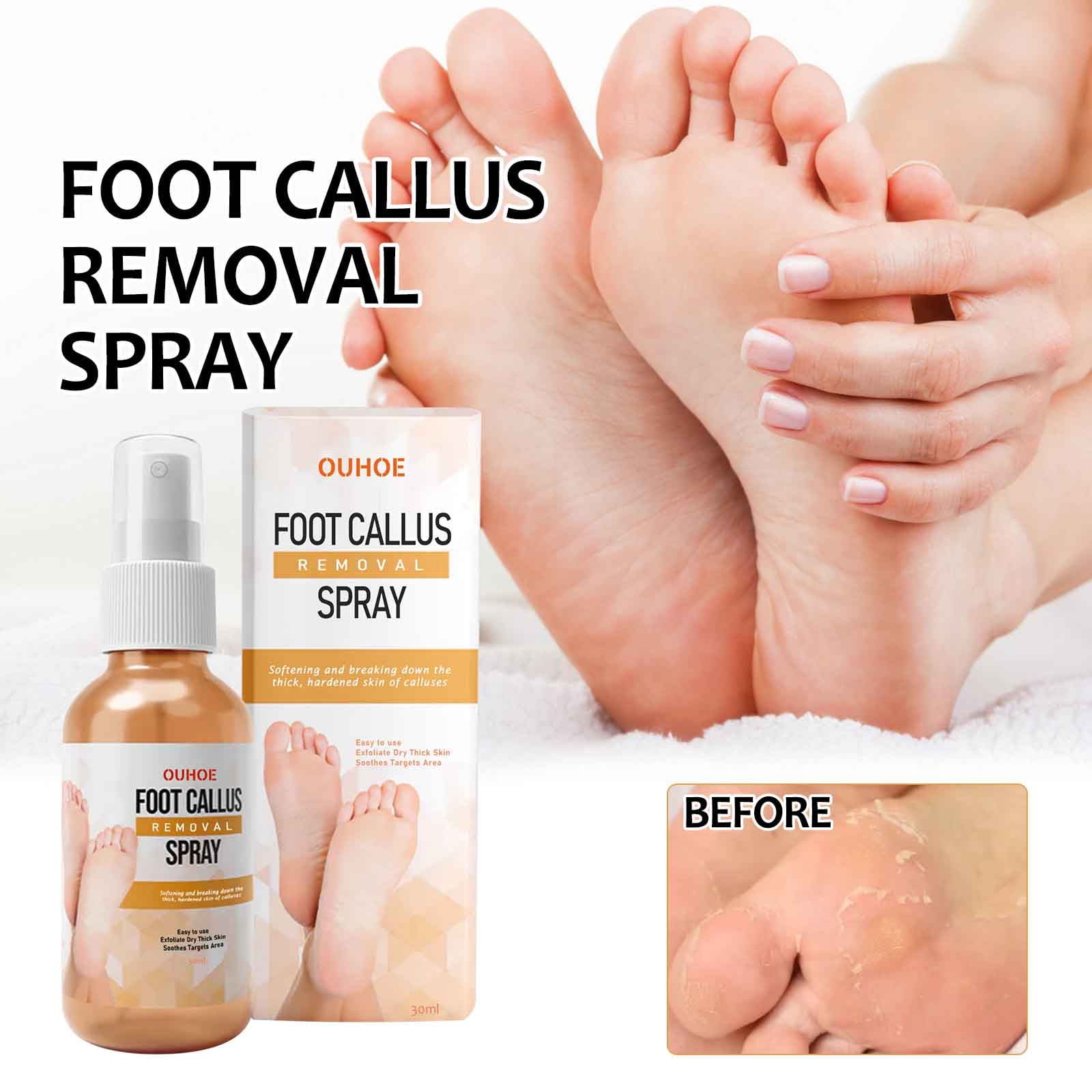Fankiway Foot Callus Remover Spray Improve Dryness And Roughness, And ...