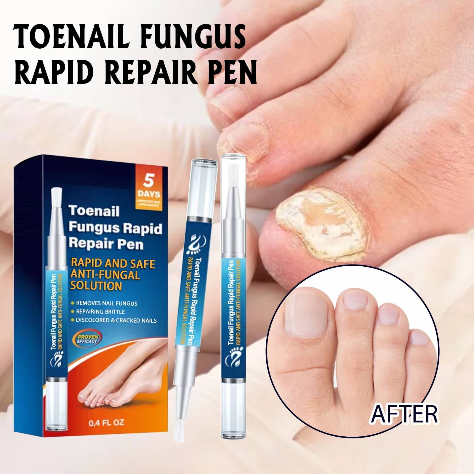Feternal Toenail Repair Pen Extra Strength - Nail Repair Solution for ...