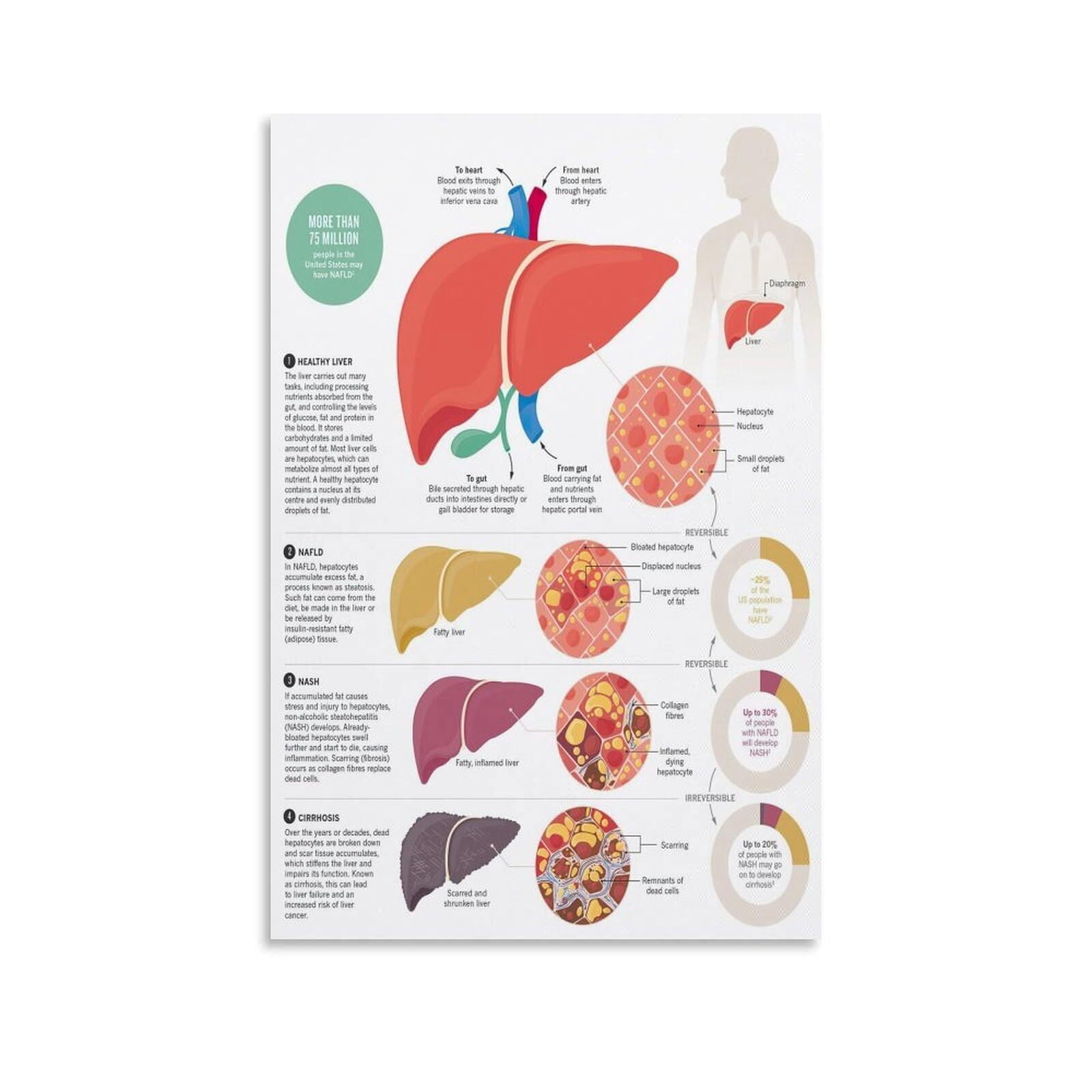 Fighting The Fatty Liver Poster Healthy Body Knowledge Posters Canvas ...