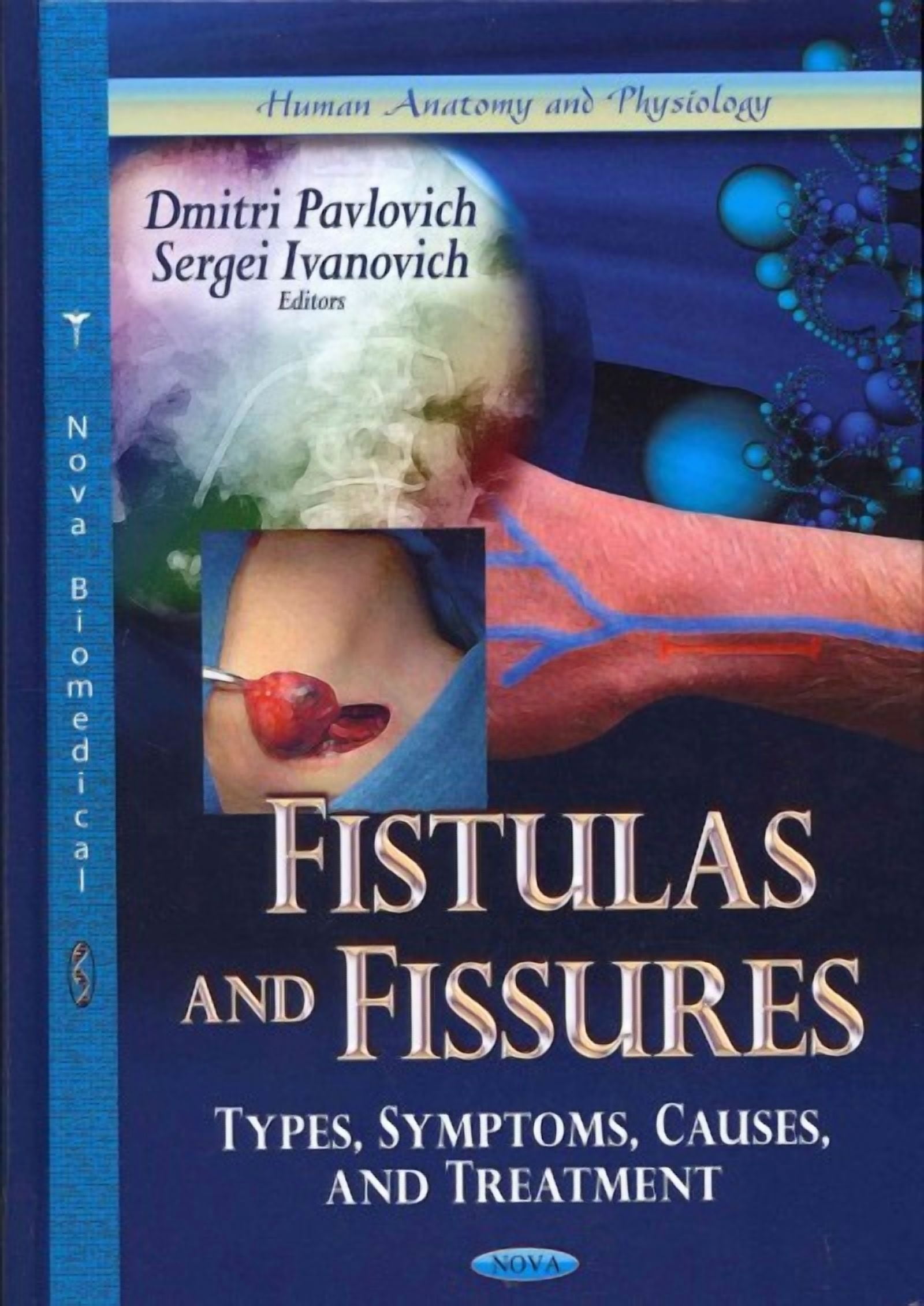 Fistulas and Fissures : Types, Symptoms, Causes, and Treatment ...