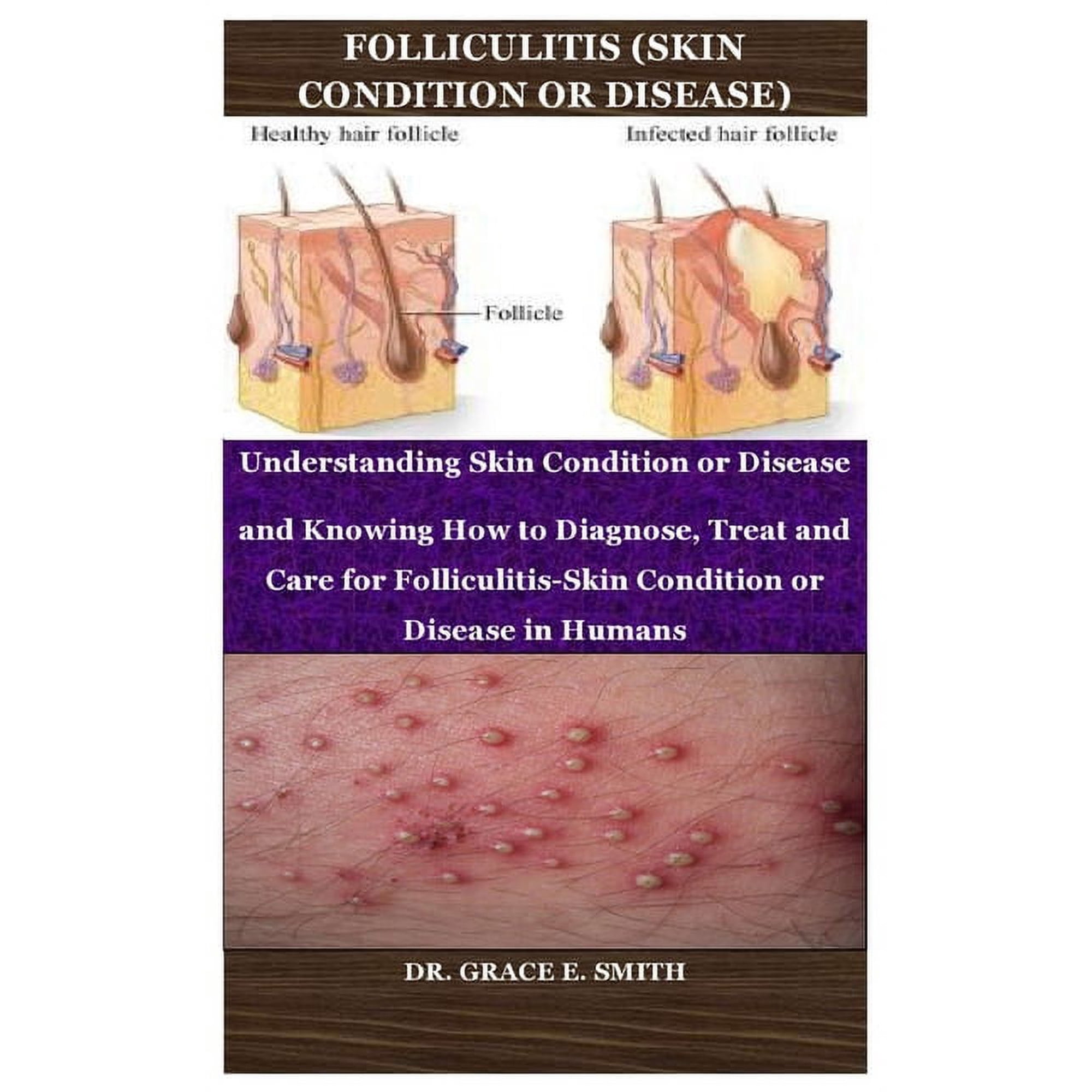 Folliculitis Testicles