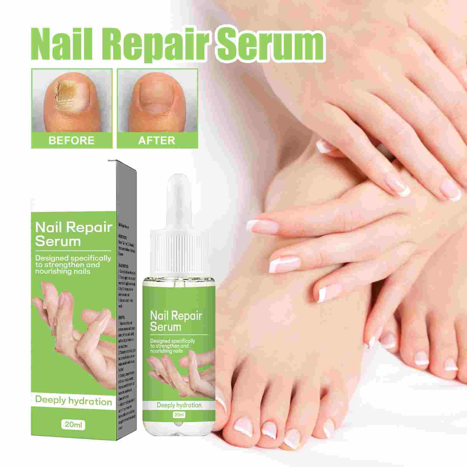 Fungal Nail Clarifying Toenail Care oil for Removing Paronychia, Nail ...