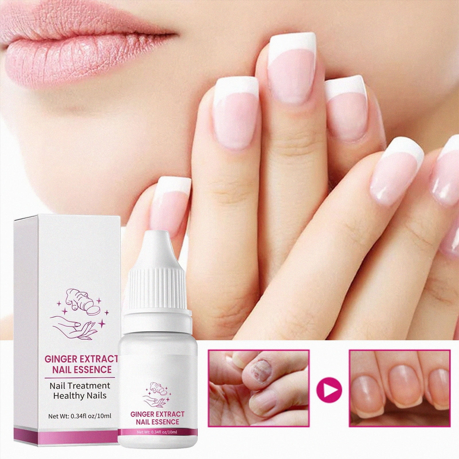 Fungigone Nail Treatment-Fungigone Nail Fungus Removal-Fungi Gone 7 Day ...