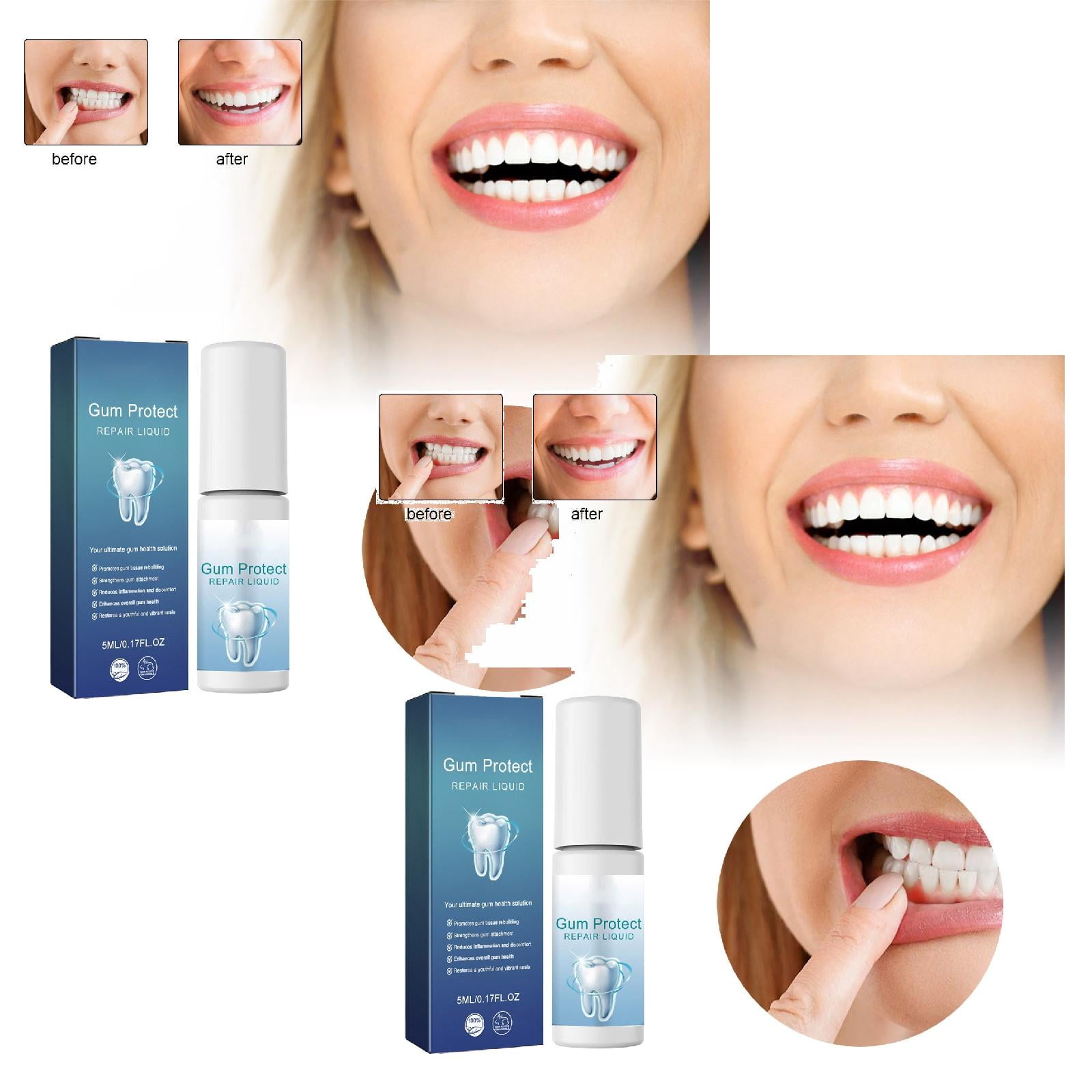 Gingival Cleaning Of Stains And Yellowing And Of Teeth Oral Health Care ...