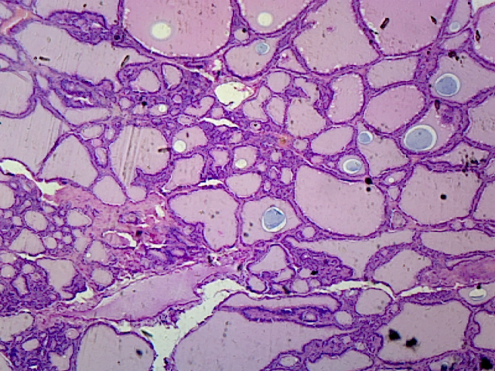 Goiter (Human Endocrine System); Section; H&E Stain by Go Science Crazy ...