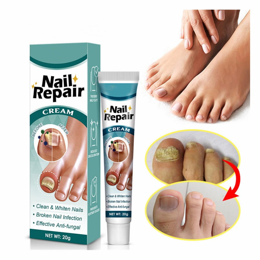 Gray Nail Toenail Cream Fingernail Toenail Cream Gray Nail Net 1/2/3 ...