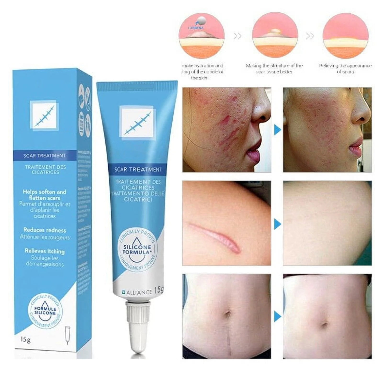 HML Scar Gel New And Old Hypertrophic Keloids Caused By General Trauma ...