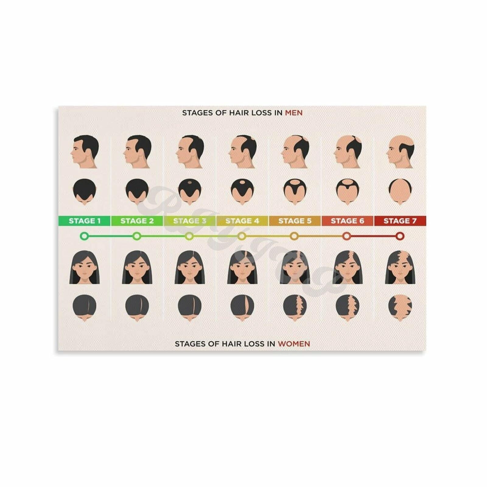 Hair Loss Stages Poster Hair Transplant Hair Loss Posterthe Ludwig ...