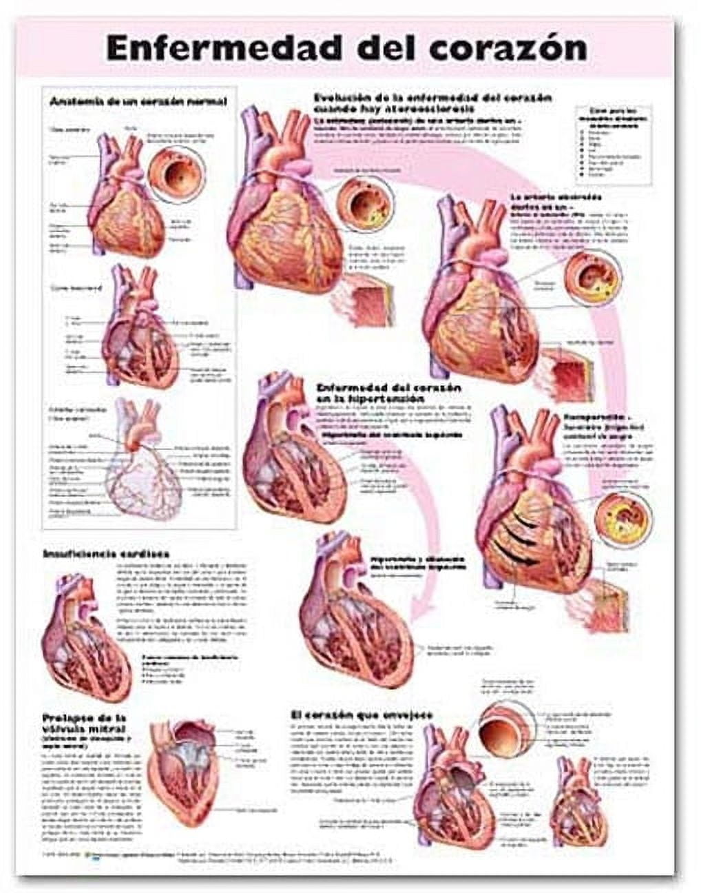 Heart Disease Anatomical Chart in Spanish (Enfermedad del corazón ...