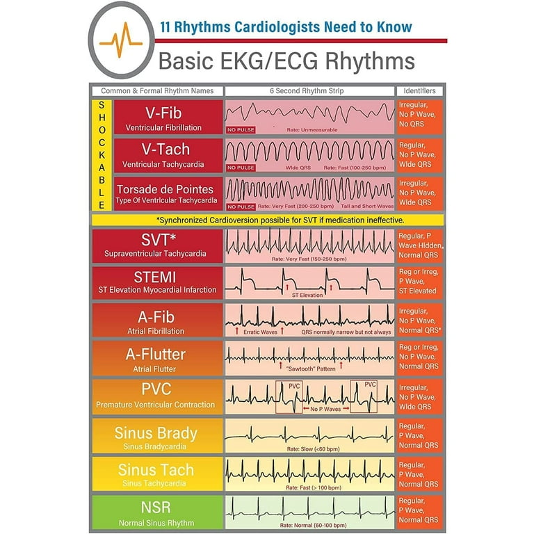 The P Wave Ecg Basics Medschool 59 Off