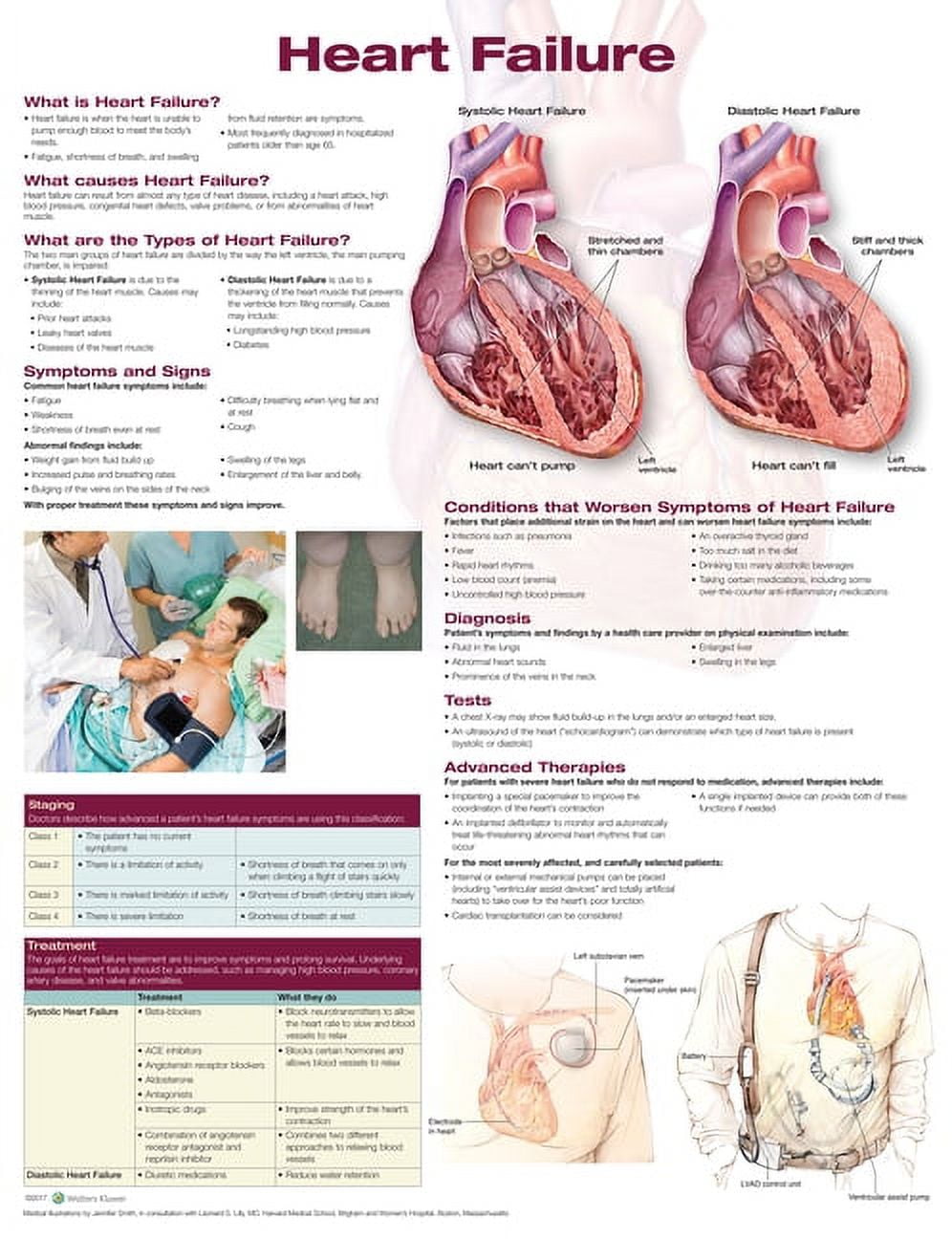Heart Failure Anatomical Chart (Other) - Walmart.com