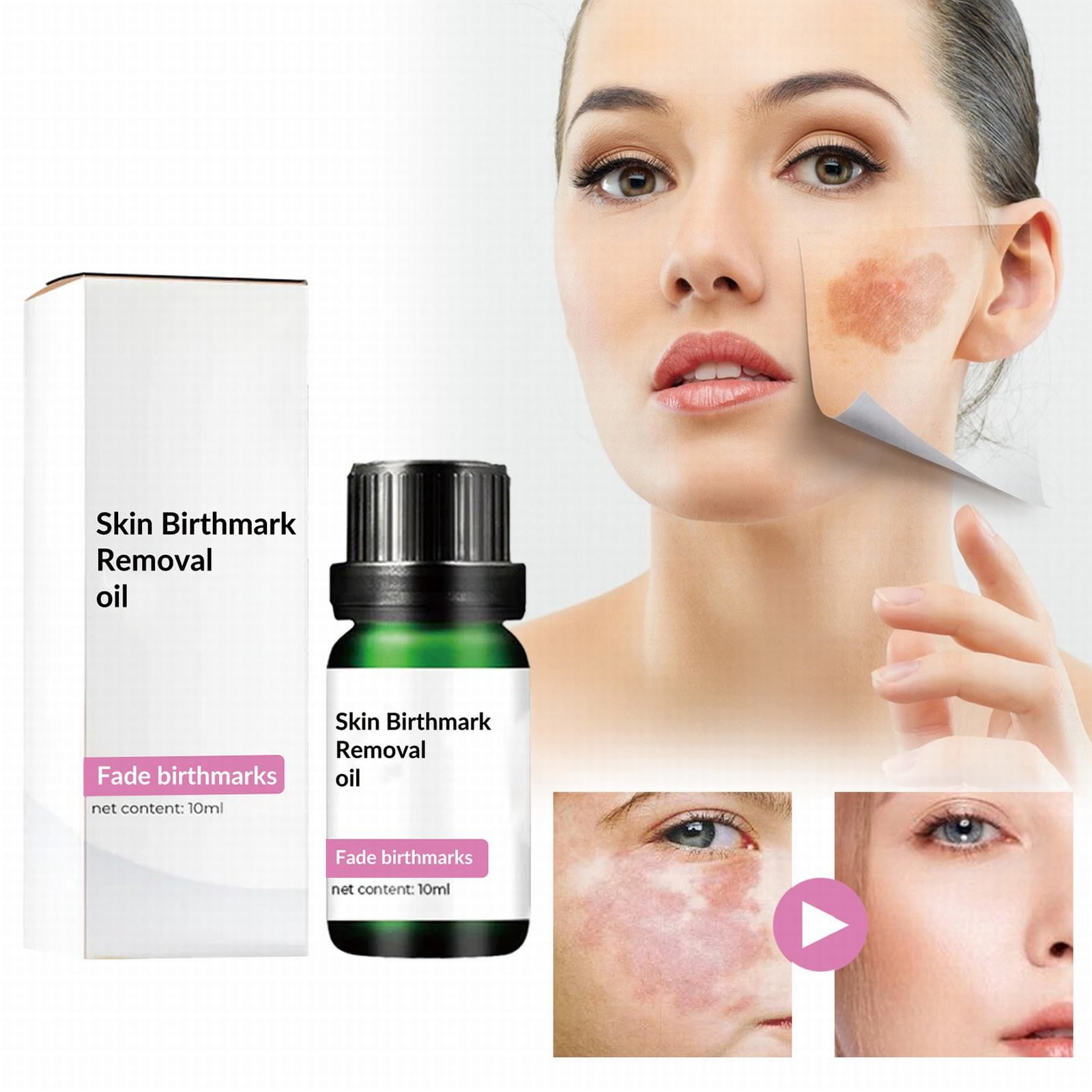 Hessimy Birthmarks Removal Desalination Removal Of Birthmarks Removal ...