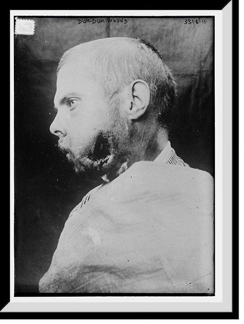 Historic Framed Print, Dum-Dum Wound man, 17-7/8" x 21-7/8" - Walmart.com