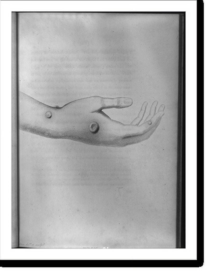 Historic Print, [Hand of Gloucestershire milkmaid Sarah Nelmes showing ...