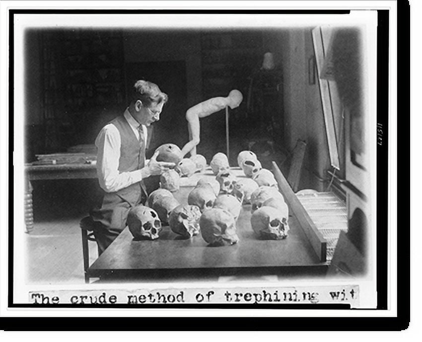 Historic Print, The crude method of trephining [sic] with the sharpened ...