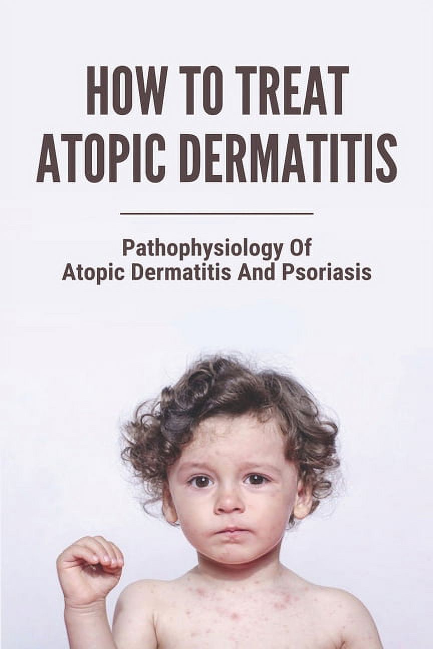 How To Treat Atopic Dermatitis : Pathophysiology Of Atopic Dermatitis ...