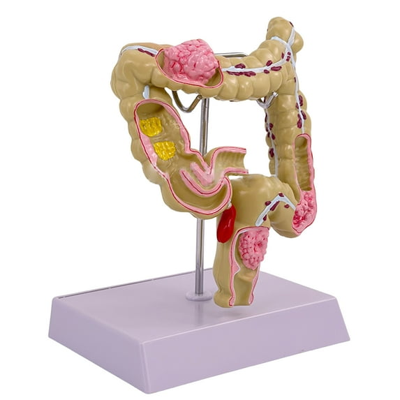 Human Anatomical Model Human Large Intestine Model Human Pathologies of ...
