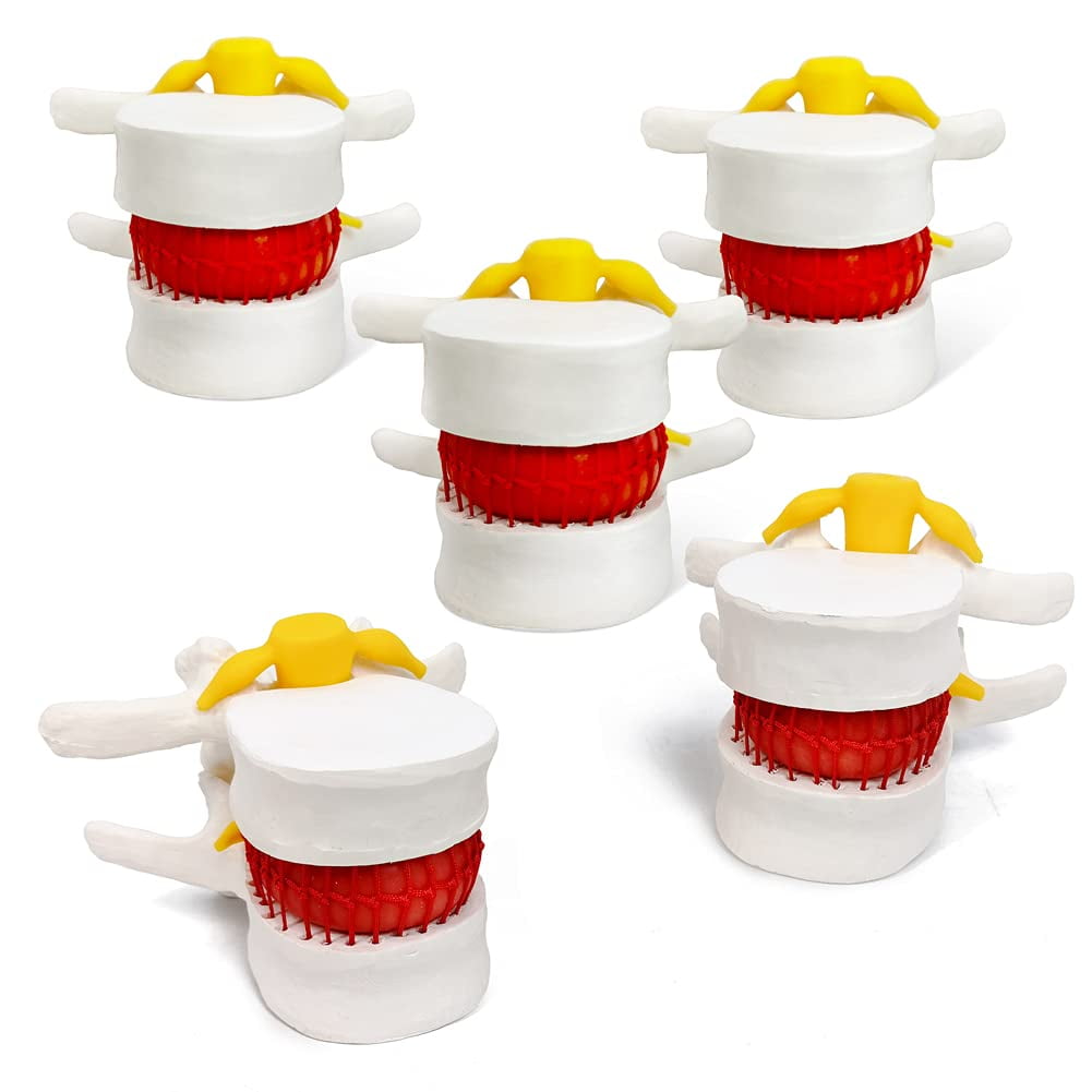 Human Herniated Disc Model, DHF10 Anatomical Herniated Lumbar Vertebrae ...