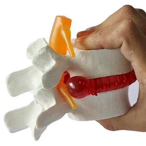 Human Lumbar Disc Herniation Demonstration Model Human Spine Anatomical ...