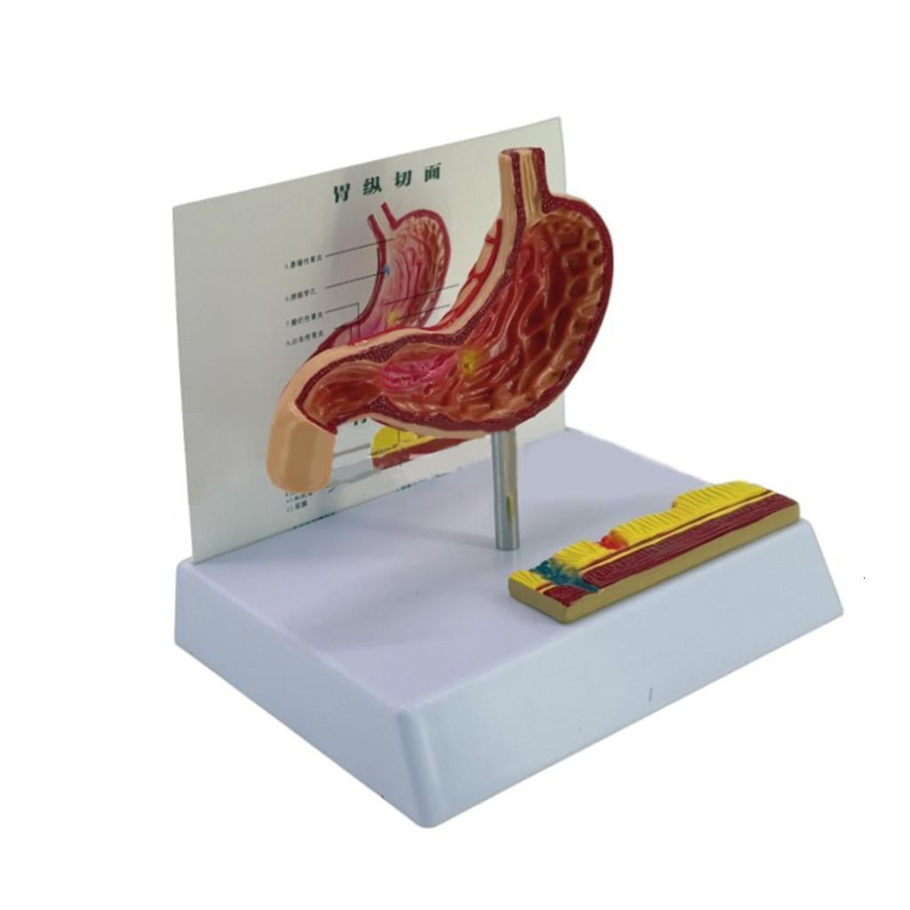 Human Pathological Stomach Anatomy Model Anatomical Gastric Perforation ...