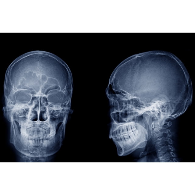 Human Skull X ray Image Front and Side Lateral View Skeleton Anatomy ...