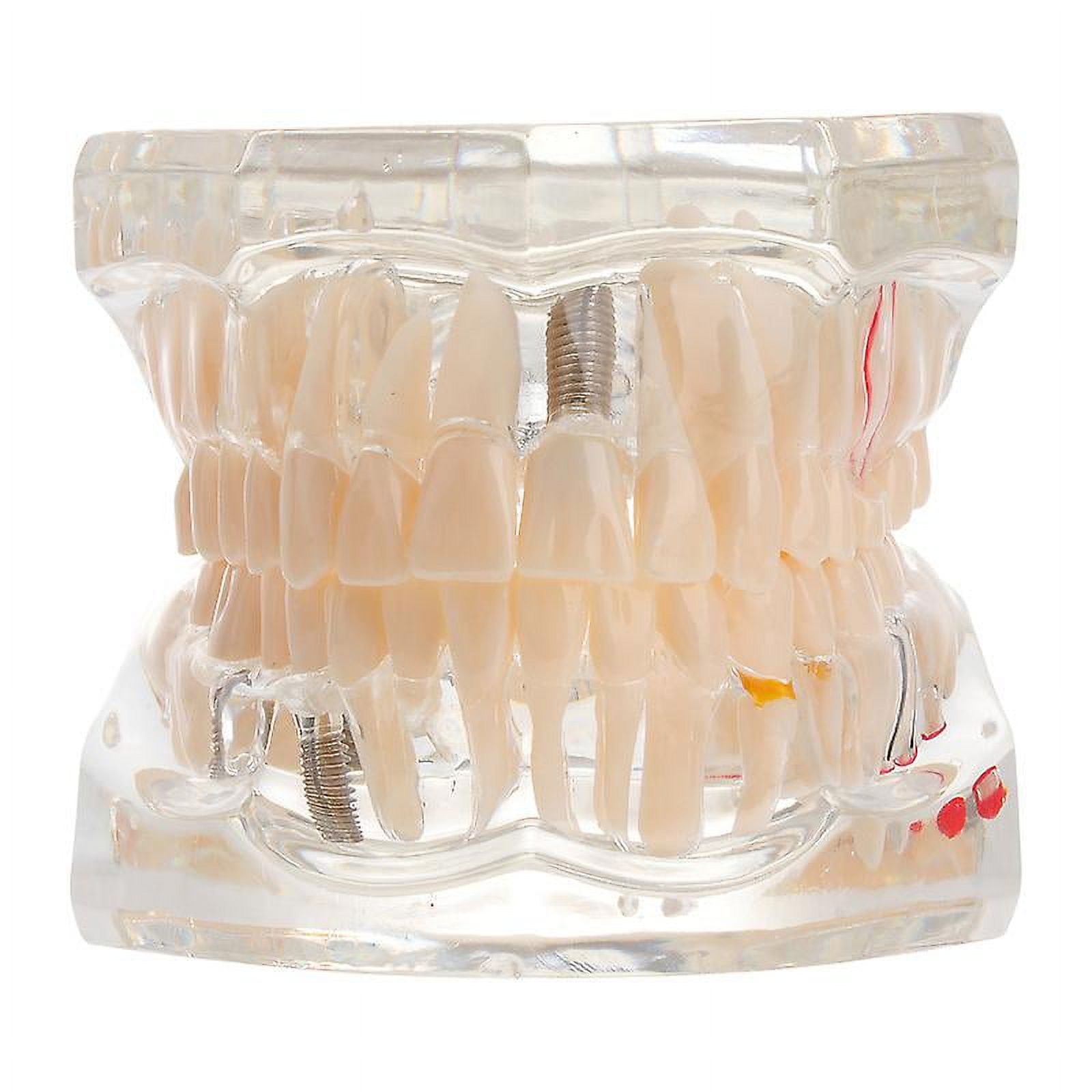 Human Teeth Anatomical Model Transparent Medical Dental Disease Oral ...
