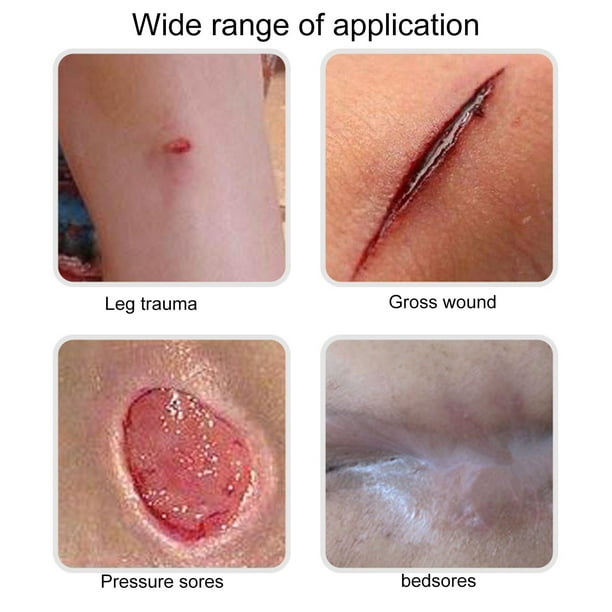 Hydrocolloid Dressing Adhesive Silicone Foam Dressing Pressure Ulcer Patch for Surgical Cuts ...
