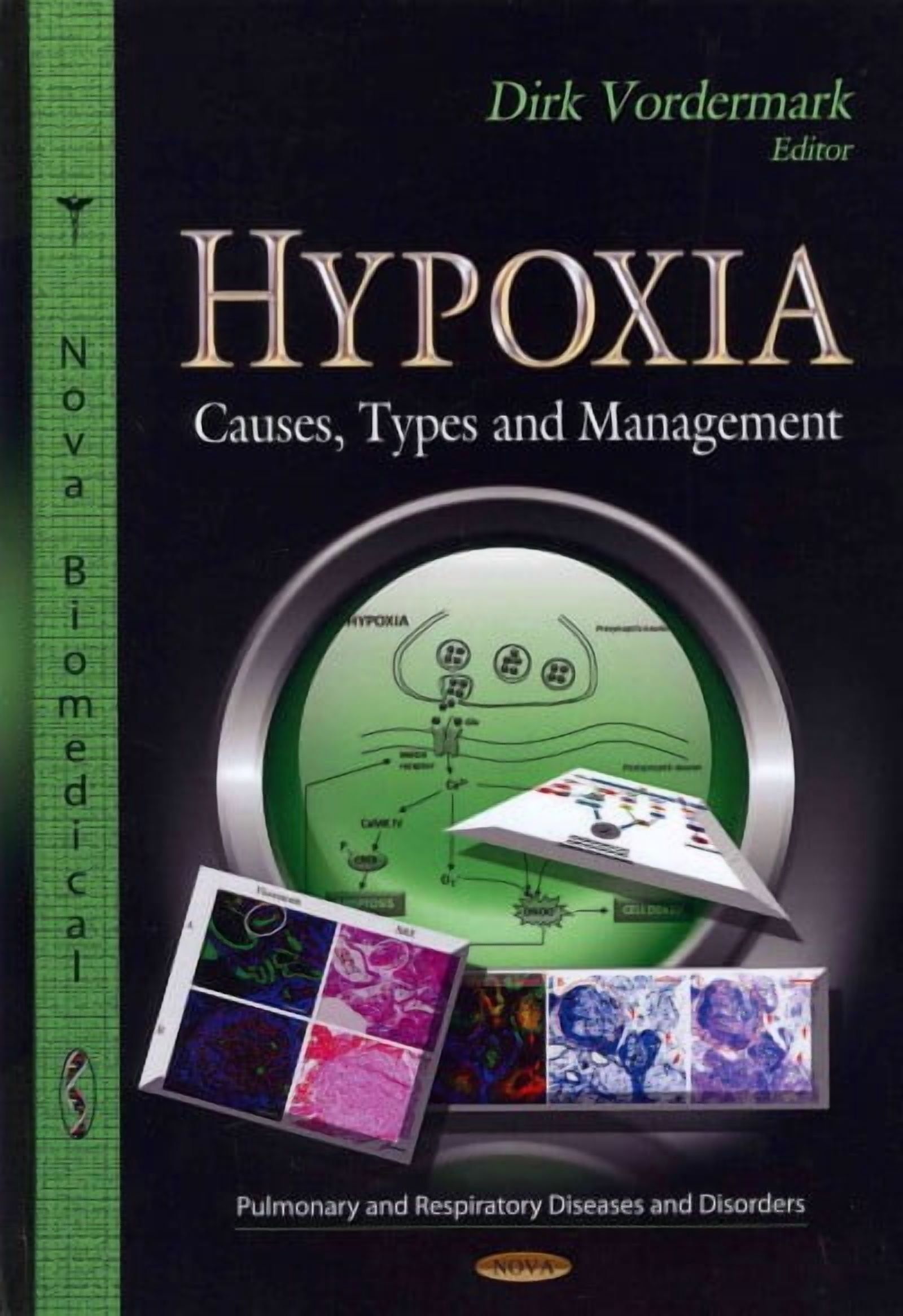 Hypoxia : Causes, Types and Management - Walmart.com